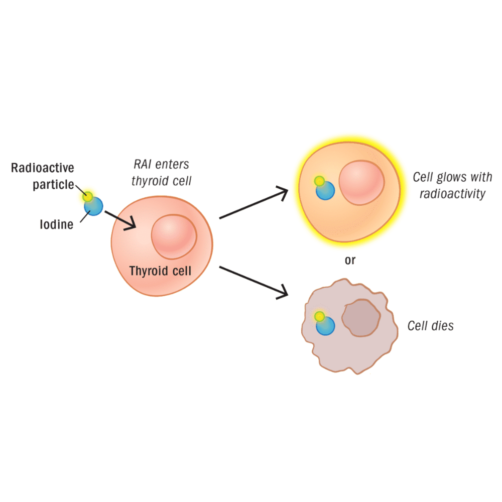 Treatment Options for Papillary Thyroid Carcinoma
