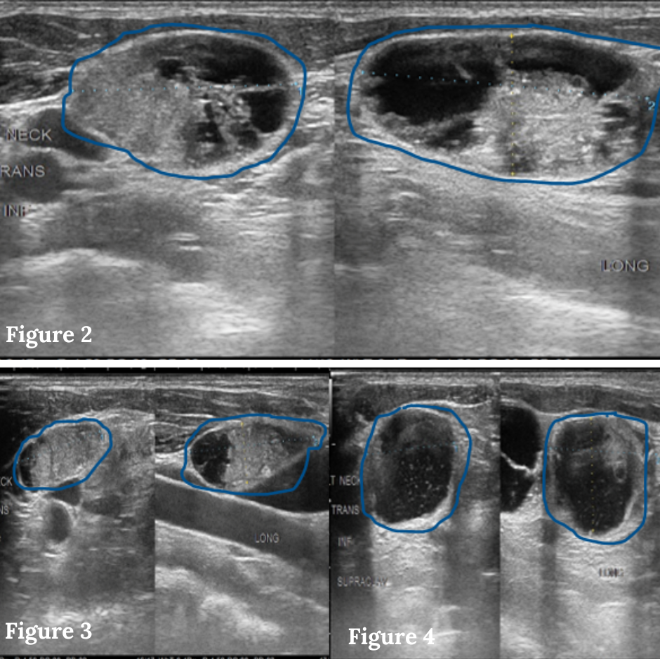 Thyroid Ultrasound for Papillary Thyroid Cancer
