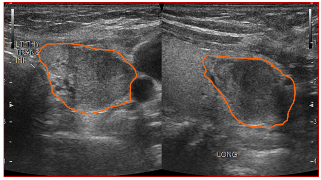 Understanding Hypoechoic Thyroid Nodules