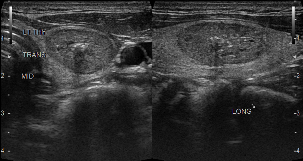 Spongiform Thyroid Nodules: Top 4 Things to Know