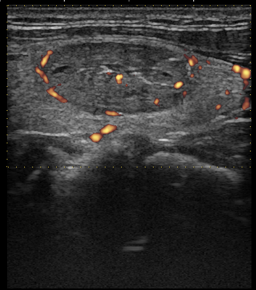 Spongiform Thyroid Nodules: Top 4 Things to Know