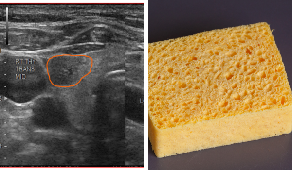 Spongiform Thyroid Nodules: Top 4 Things to Know