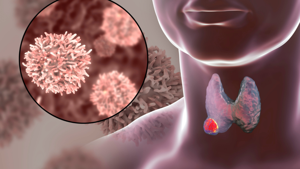 Thyroid cancer metastasis sites: What you need to know