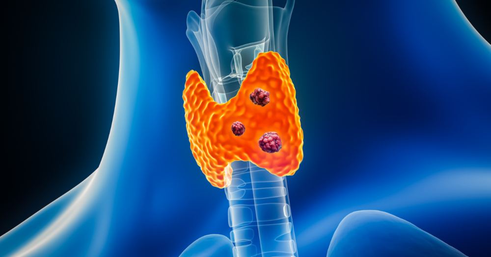 Understanding Tall Cell Variant of Papillary Thyroid Cancer