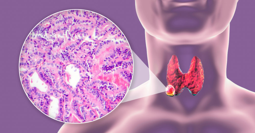 Types of Thyroid Cancer: Understanding the Differences and Importance ...